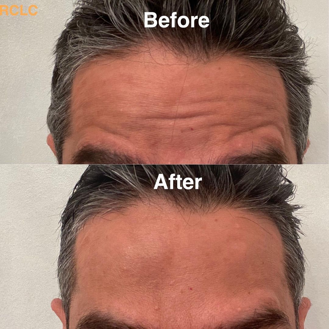 Botox Treatment for Men in Richmond, BC | DaVinci Cosmetic