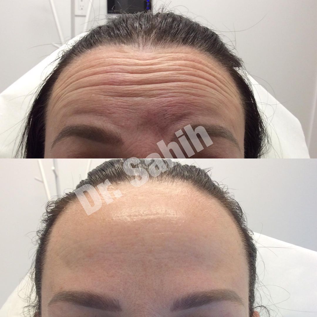 Botox Anti-Wrinkle Treatment in Richmond | DaVinci Cosmetic