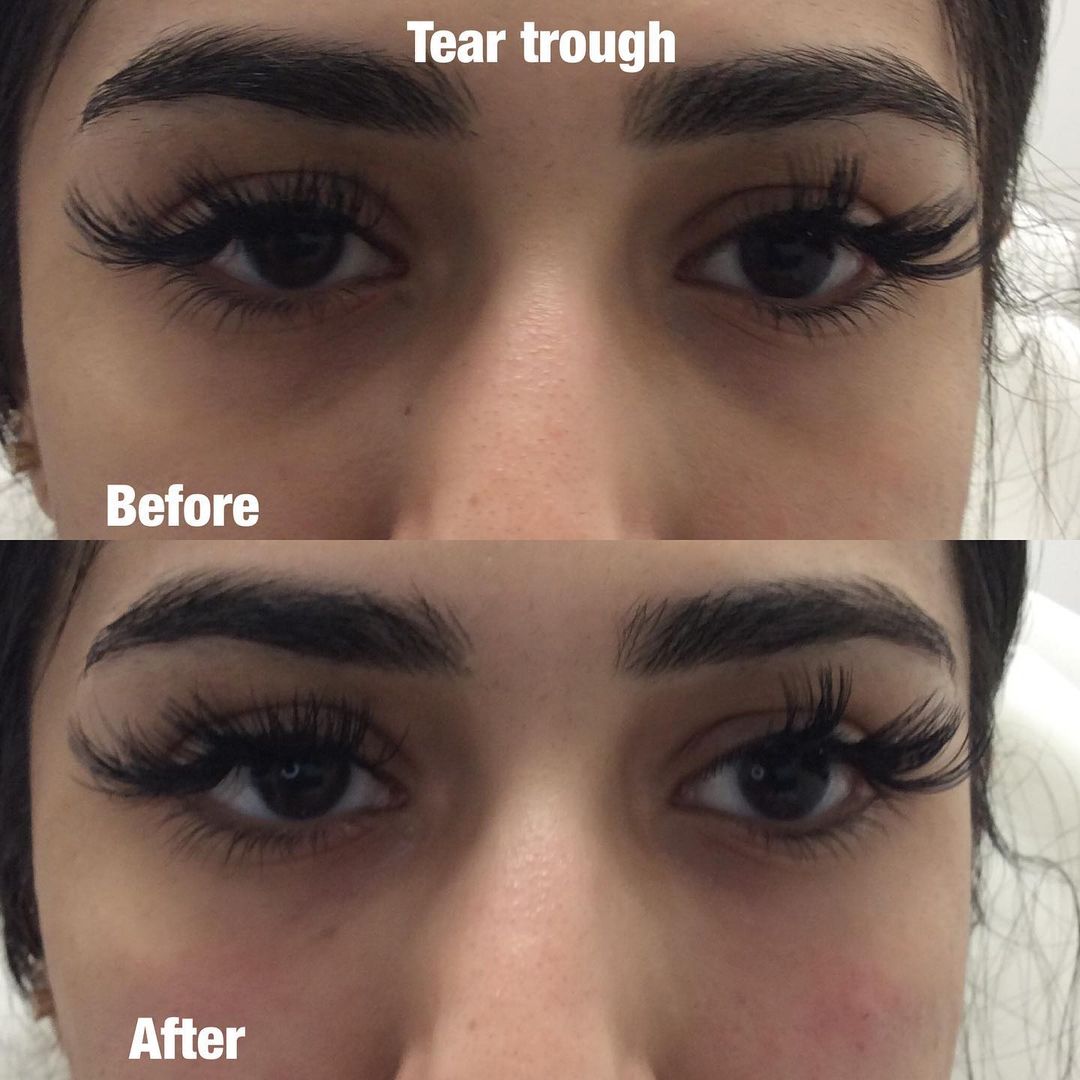 Lateral Lift Treatment in Vancouver | DaVinci Cosmetic